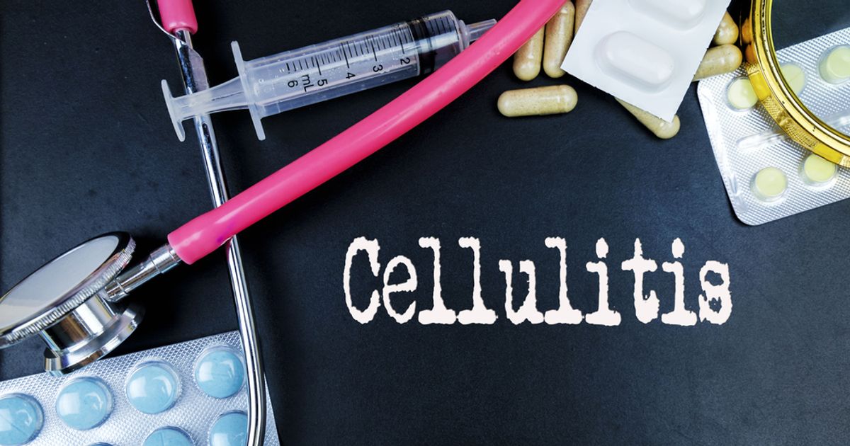 10 General Symptoms of Cellulitis - Facty Health