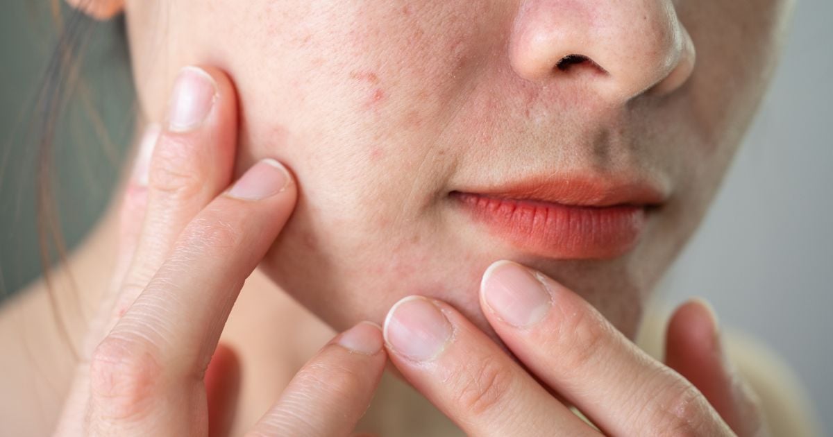 11 Pimple Remedies: Simple Solutions for Clear Skin - Facty Health