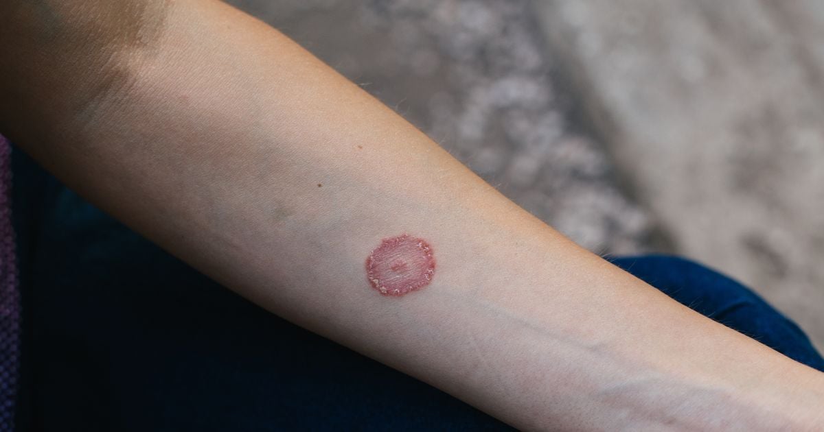 Recognizing Ringworm: 10 Key Symptoms - Facty Health