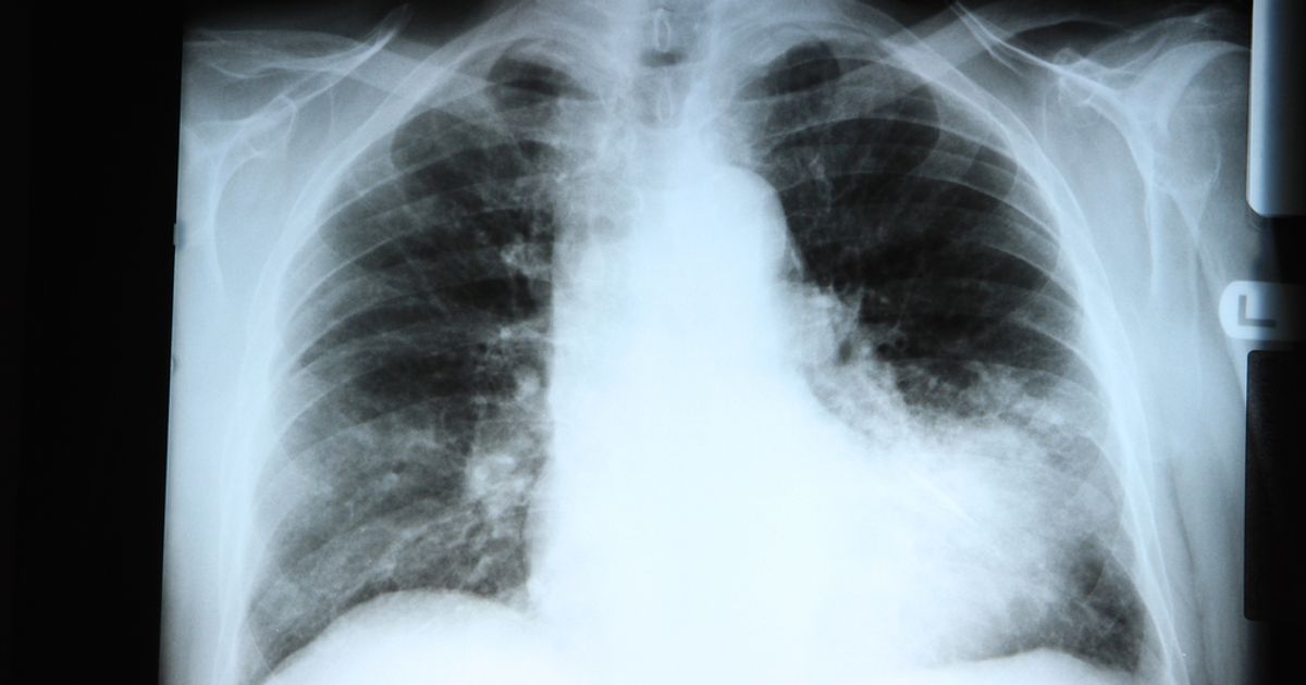 10 Causes of Pneumonia - Facty Health