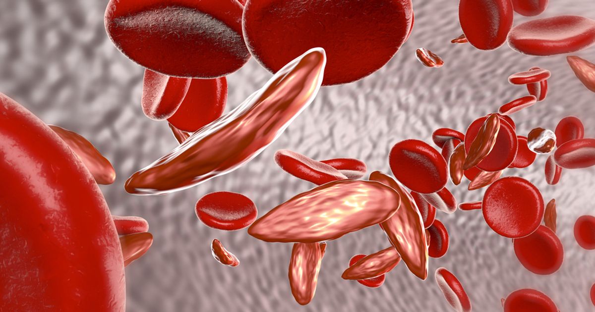 10 Symptoms of Sickle Cell Anemia - Facty Health