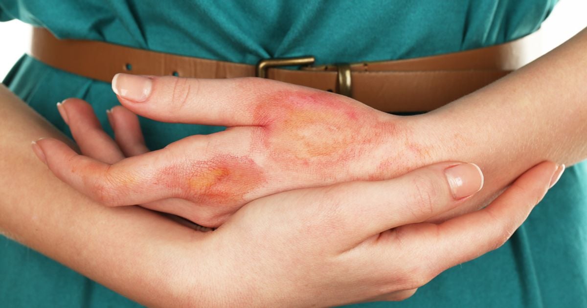 10 Home Remedies for Burns - Facty Health