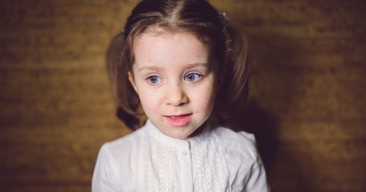 10 Symptoms of Smallpox - Facty Health