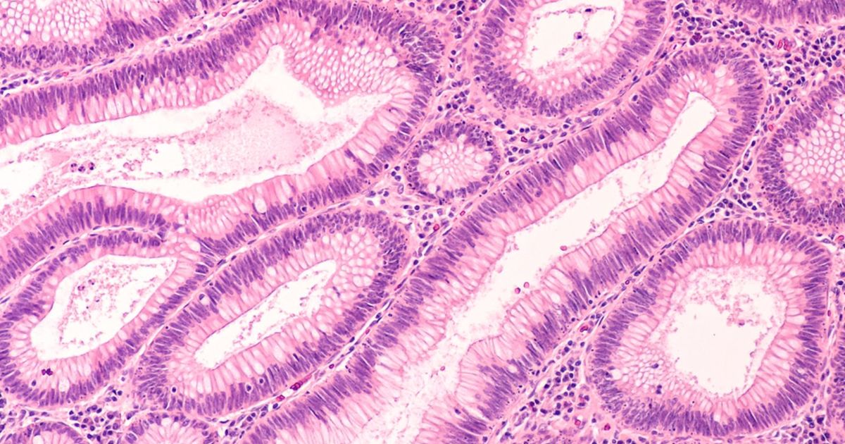 10 Common Colon Polyp Types - Facty Health