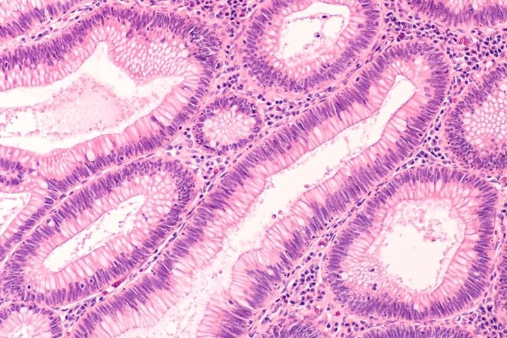 10 Common Colon Polyp Types - Facty Health