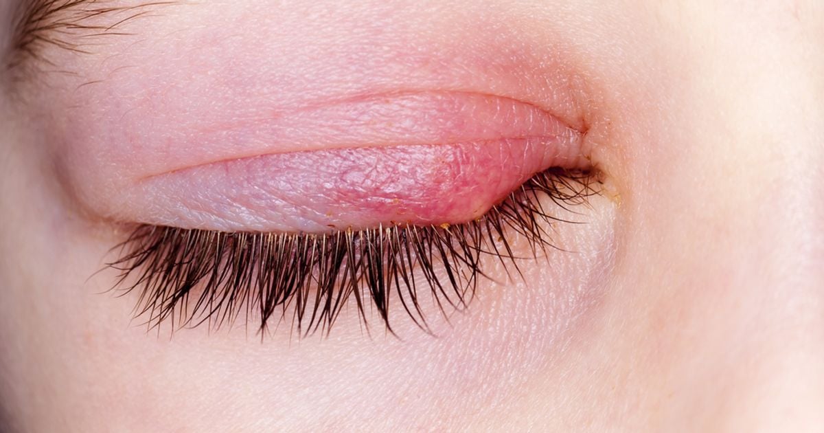 13 Causes of Red Eye - Facty Health