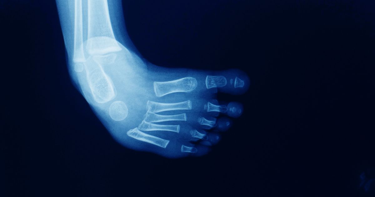 What is Clubfoot? Treatments and Symptoms - Facty Health
