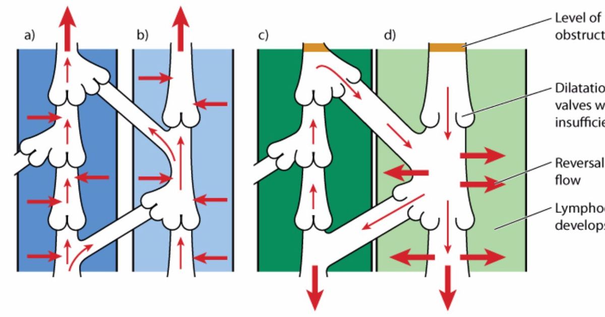 10 Treatments for Lymphoedema - Facty Health