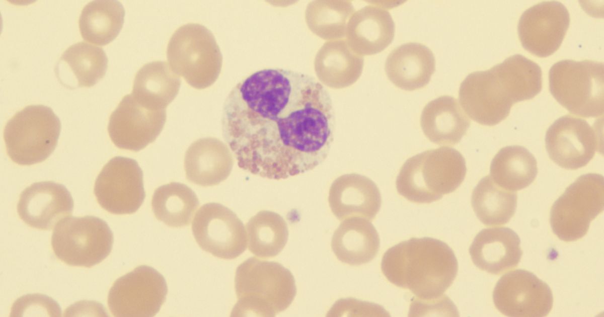 Symptoms and Treatments of Myelodysplastic Syndrome - Facty Health