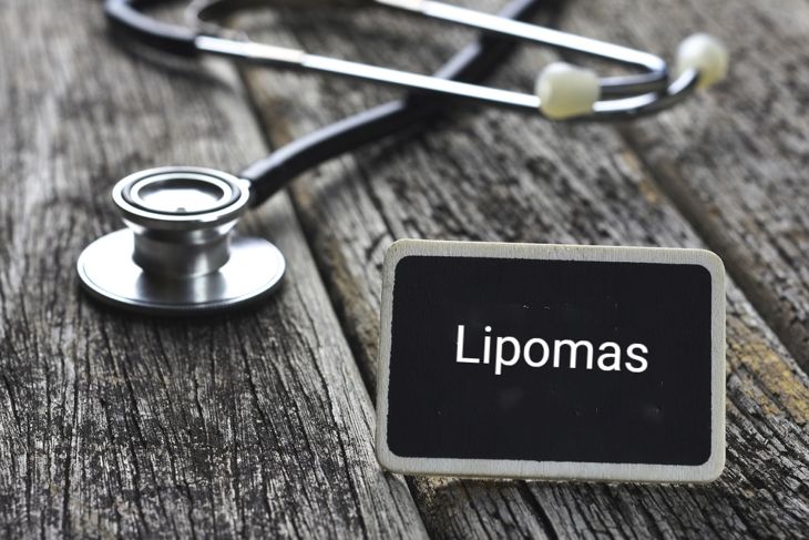 Lipoma: Causes, Symptoms, and Natural Treatments - Facty Health