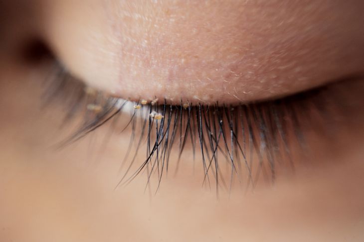 Chalazia: Symptoms and Treatments - Facty Health