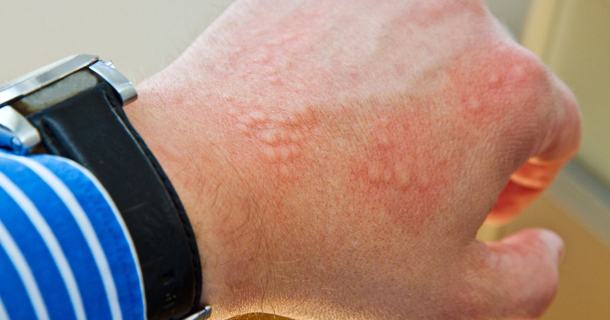 Symptoms and Treatments for Miliaria - Facty Health