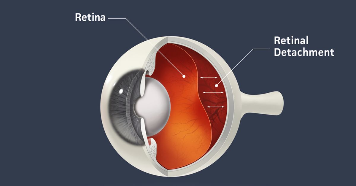 What Is Hemianopia (Hemianopsia)? - Facty Health