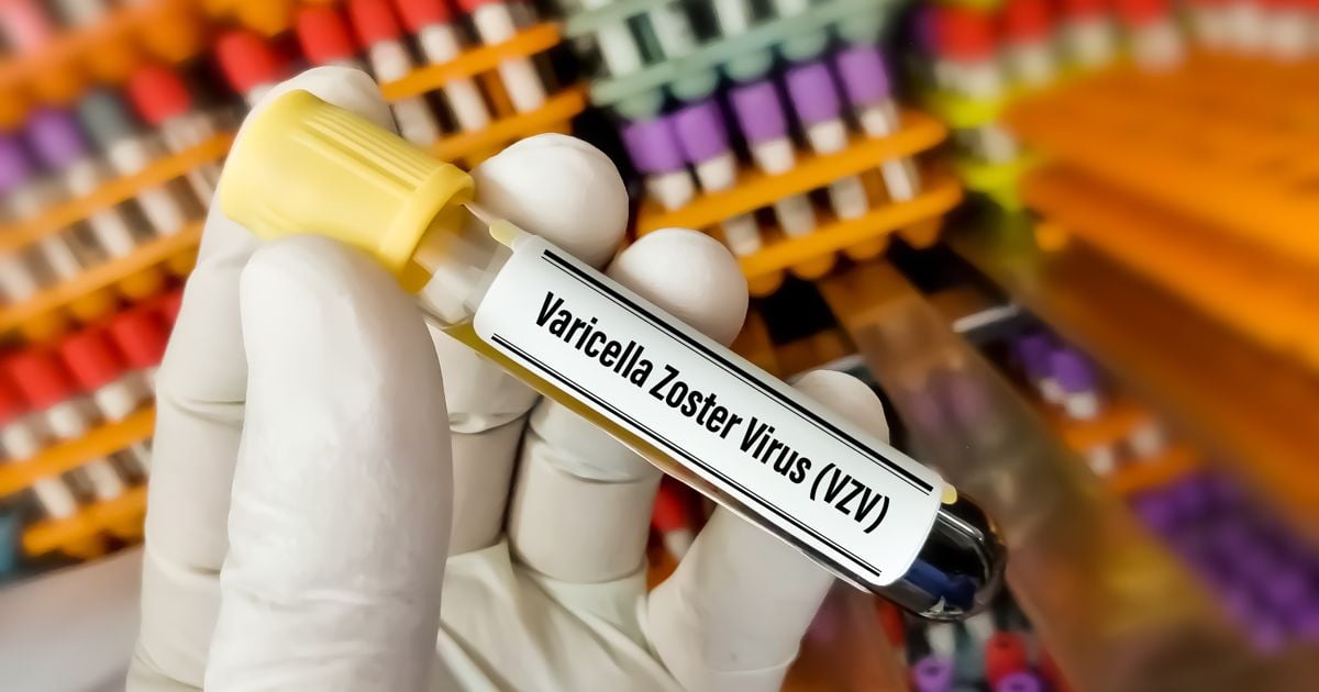 Understanding the Contagious Nature of Shingles - Facty Health