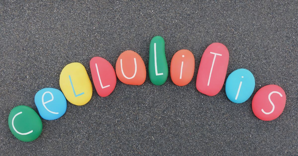 Do You Know What Causes Cellulitis? - Facty Health