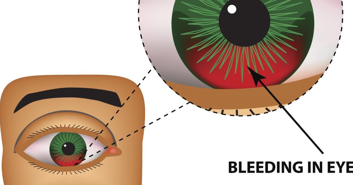 What is Hyphema? - Facty Health