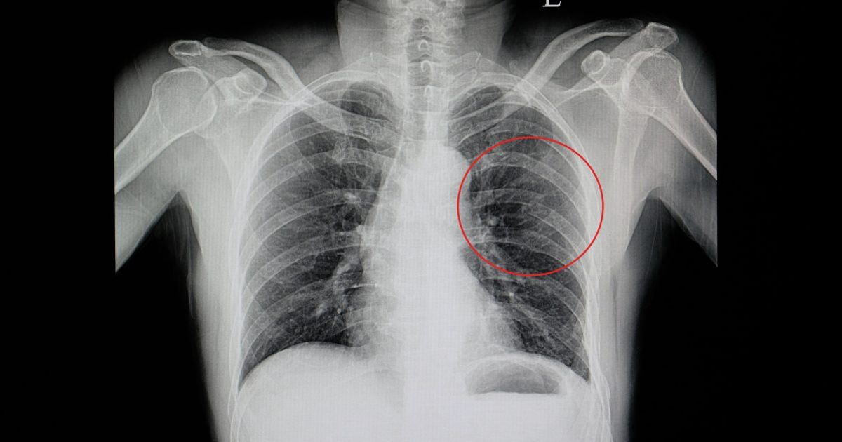 Causes, Symptoms, and Treatment of Rib Injuries - Facty Health