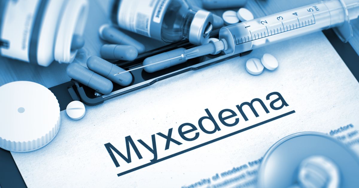 Symptoms and Causes of Myxedema - Facty Health