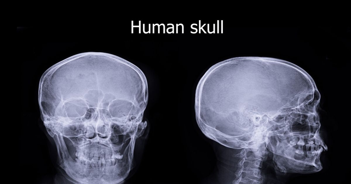 10 Facts About Apert Syndrome - Facty Health