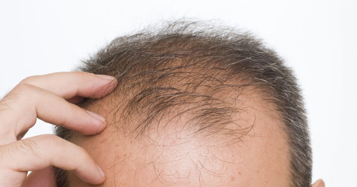 Frequently Asked Questions About Diffuse Hair Loss - Facty Health