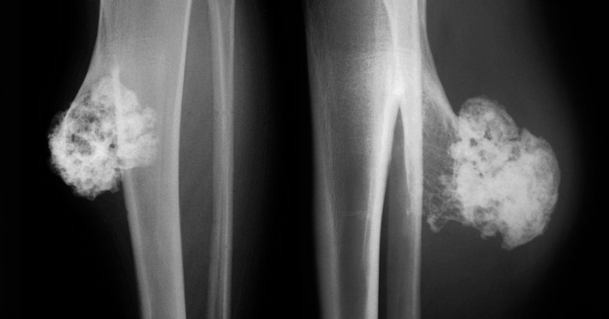 Facts About Osteochondroma - Facty Health