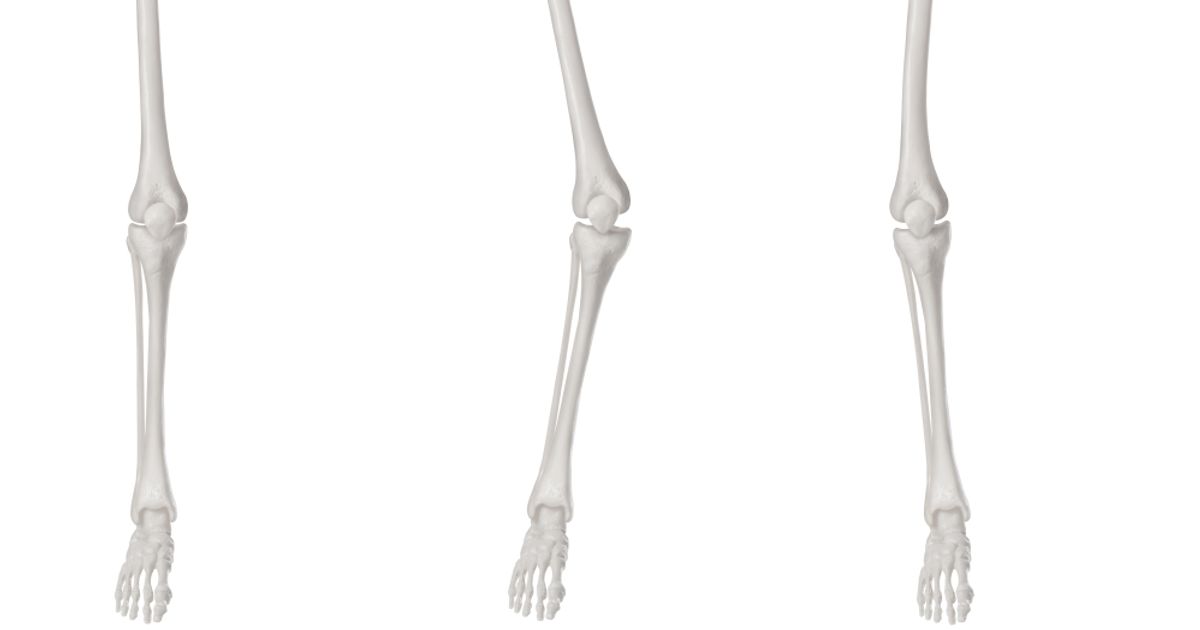 Facts About Varus Deformity - Facty Health