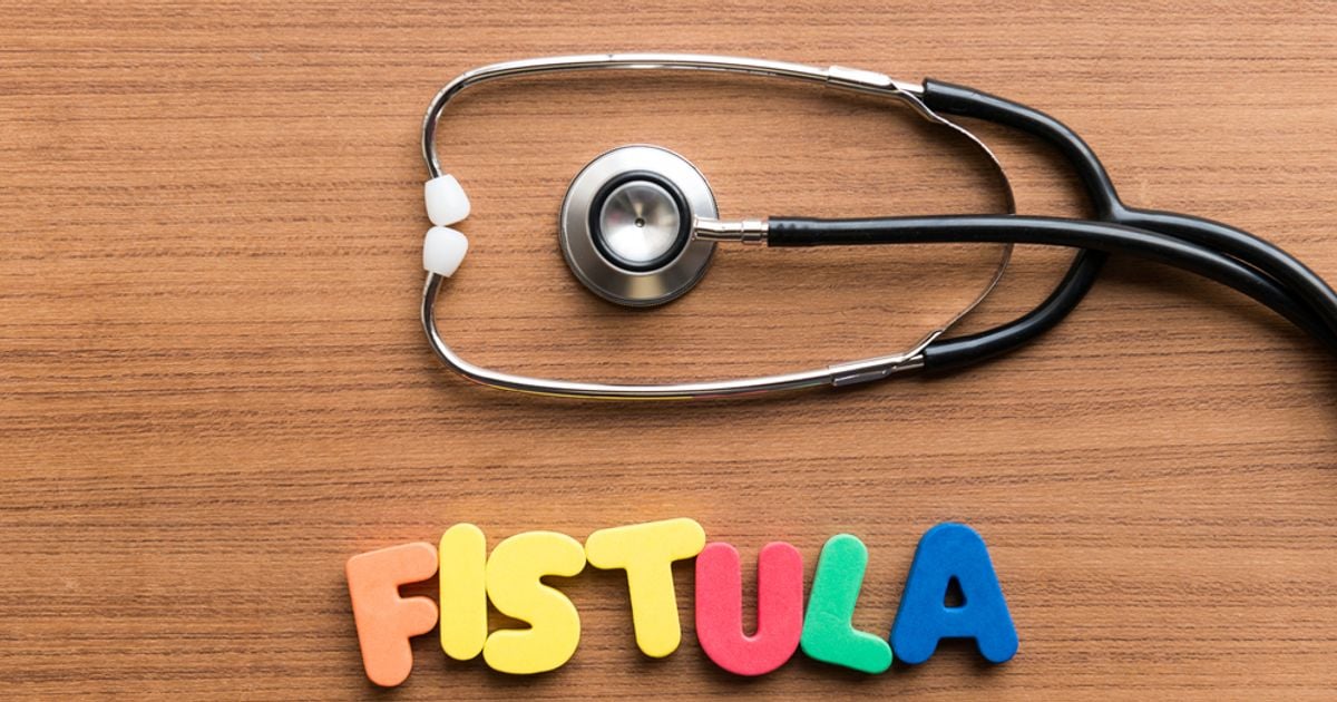 10 Facts About Fistulas - Facty Health