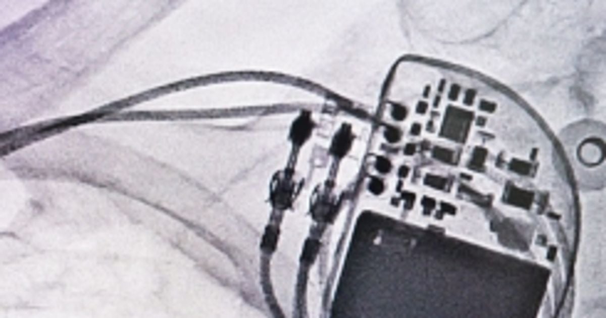 Understanding the Function and Design of Pacemakers - Facty Health
