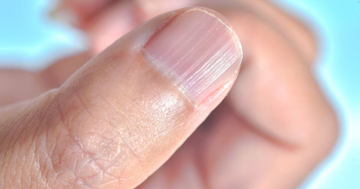 Understanding the Causes and Treatments for Fingernail Ridges - Facty ...