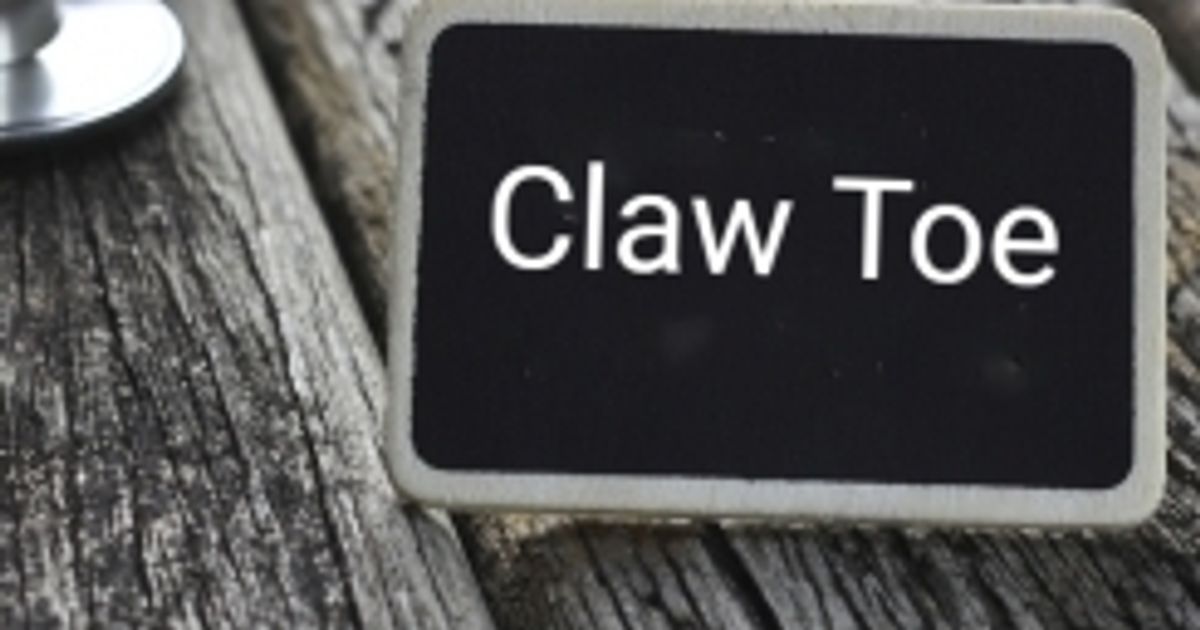 What is Claw Toe? - Facty Health