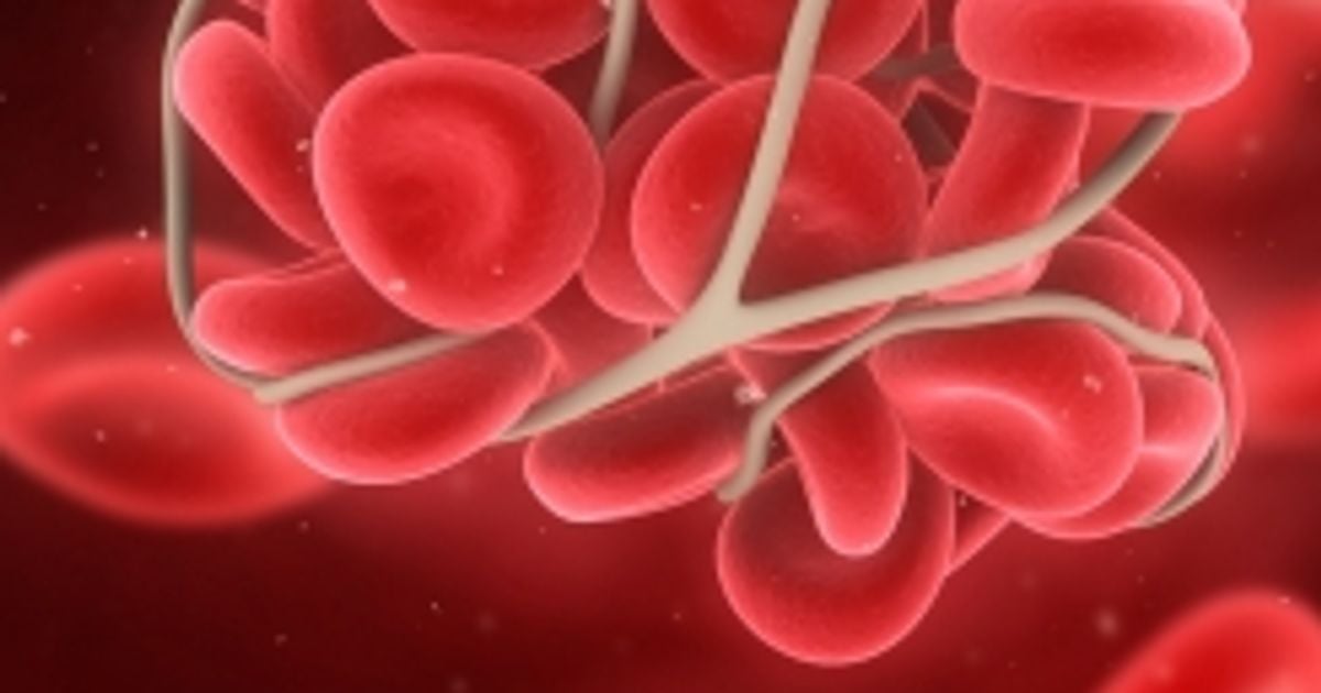 Everything You Need to Know About Phleboliths - Facty Health