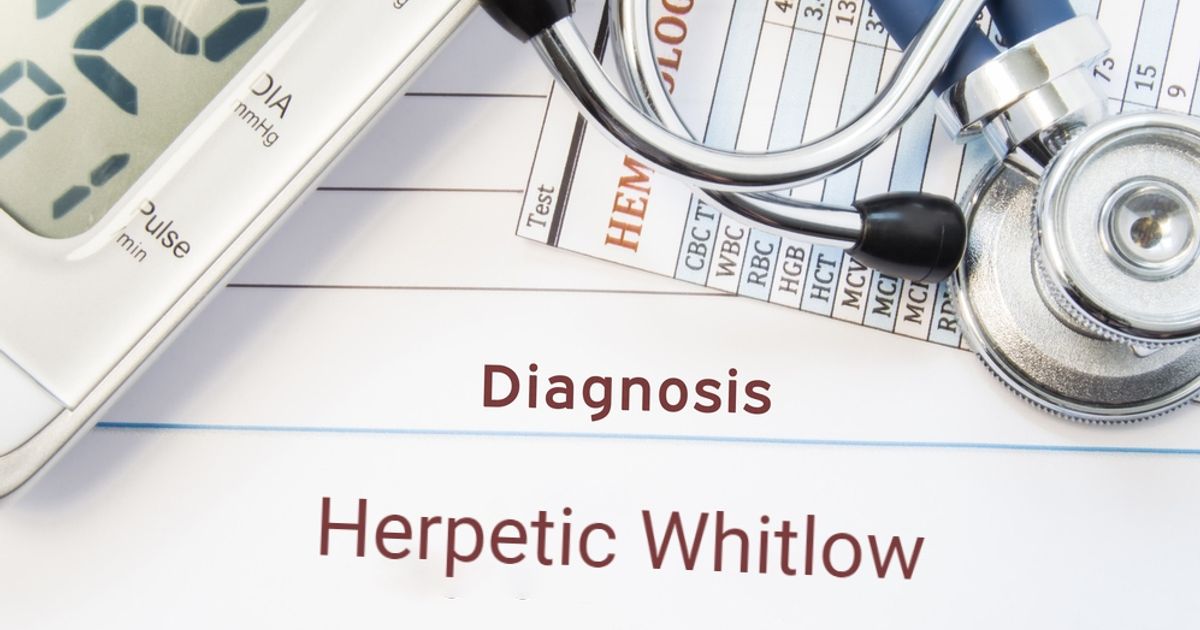 What is Herpetic Whitlow? - Facty Health