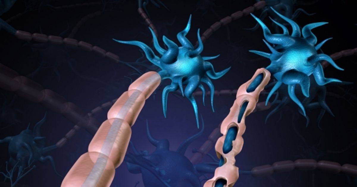 Causes and Effects of Demyelination - Facty Health