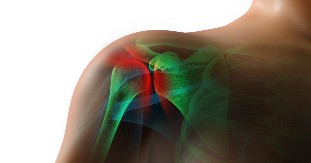 The Causes and Effects of Shoulder Impingement - Facty Health