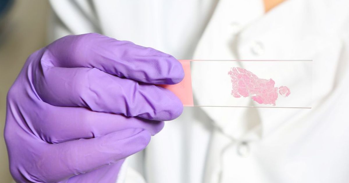 What Are the Different Types and Treatments of Neoplasms? - Facty Health