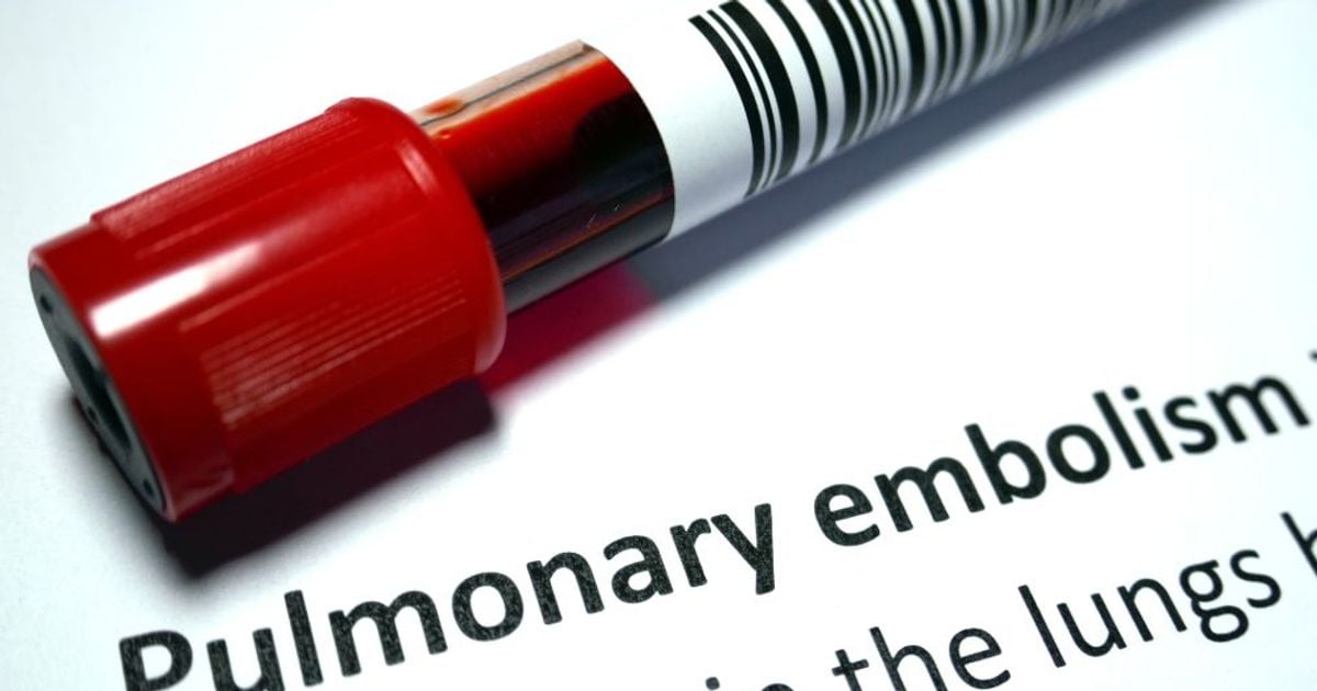Understanding Pulmonary Embolism: Symptoms, Causes, and Prevention ...