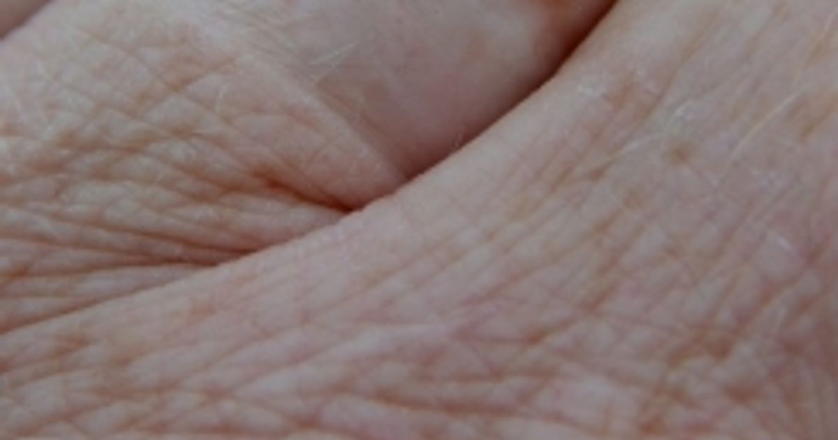 Anasarca: Generalized Edema - Facty Health