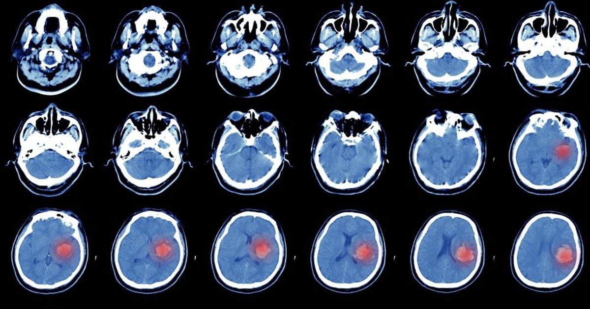 What Is a Hemorrhagic Stroke? - Facty Health
