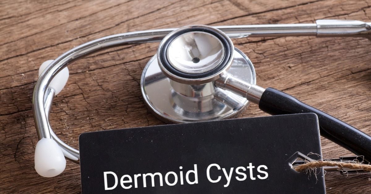 What are Dermoid Cysts? - Facty Health