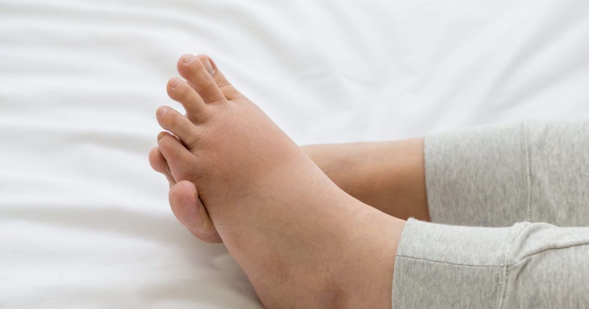 Elephantiasis: A Rare Tropical Disease - Facty Health