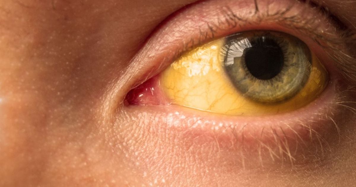 Medical Causes of Yellow Eyes - Facty Health
