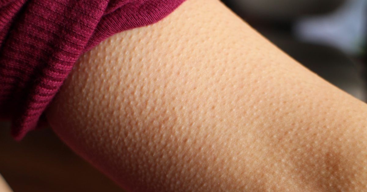 Serious And Not So Serious Causes Of Goosebumps Facty Health