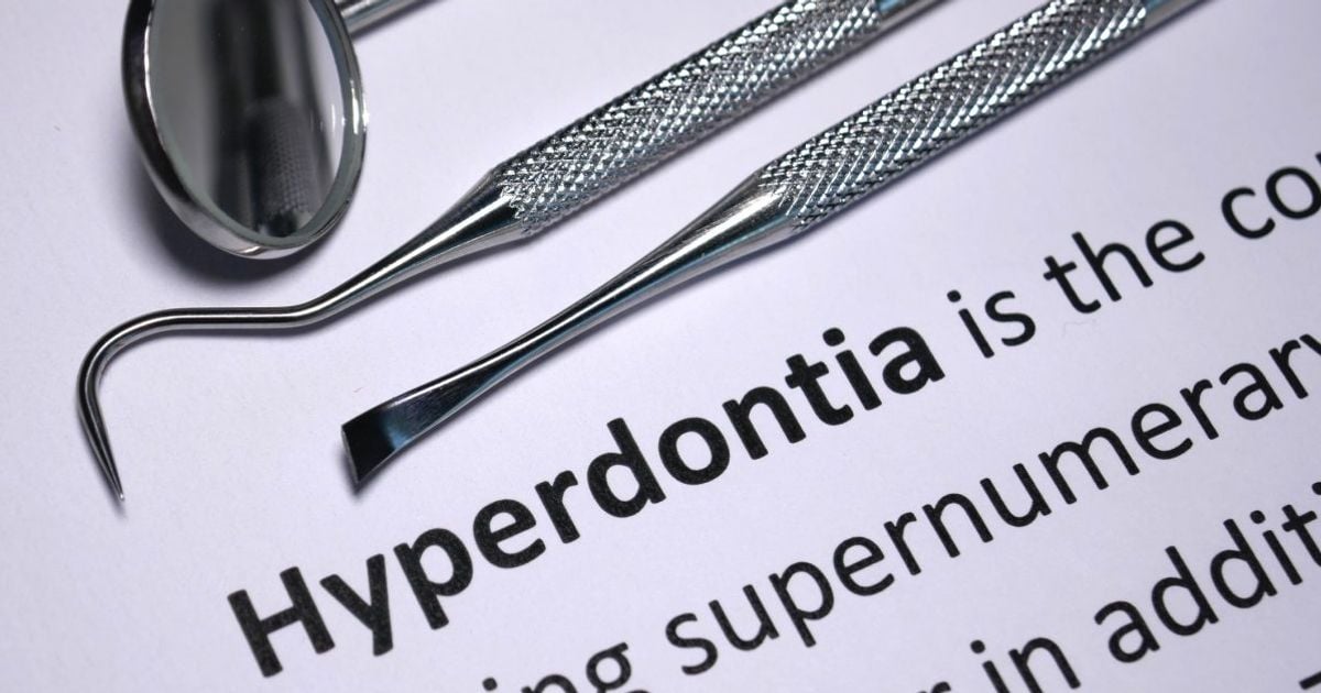 Hyperdontia: Are Extra Teeth a Problem? - Facty Health