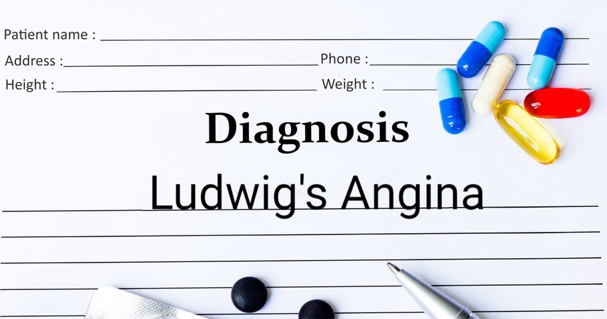 Understanding, Treating, and Preventing Ludwig's Angina - Facty Health