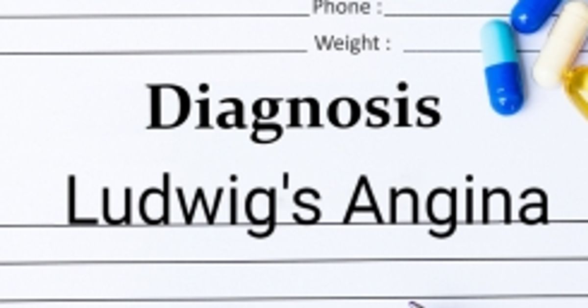 Understanding, Treating, and Preventing Ludwig's Angina - Facty Health
