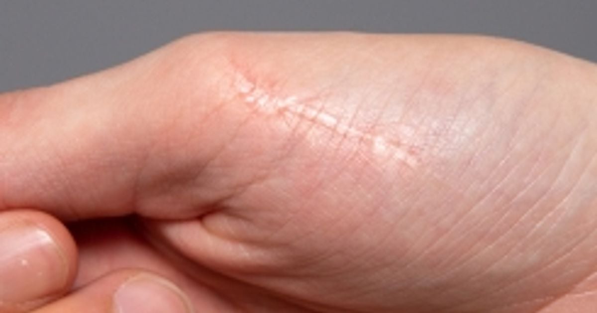 Types of Scar Tissue and How to Prevent Them - Facty Health