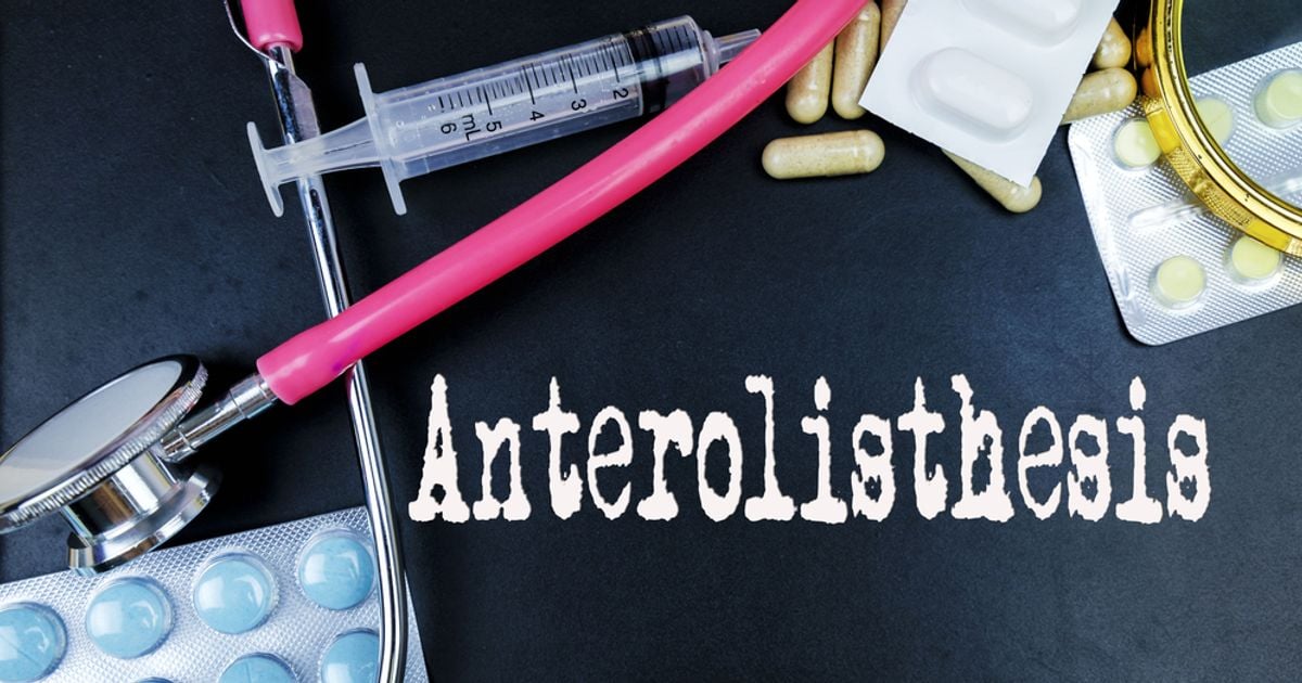 What is Anterolisthesis? - Facty Health