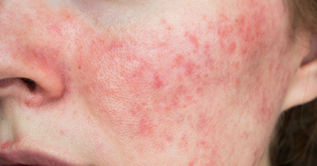 Demodex Mites: Diagnosis, Treatment, and Prevention - Facty Health