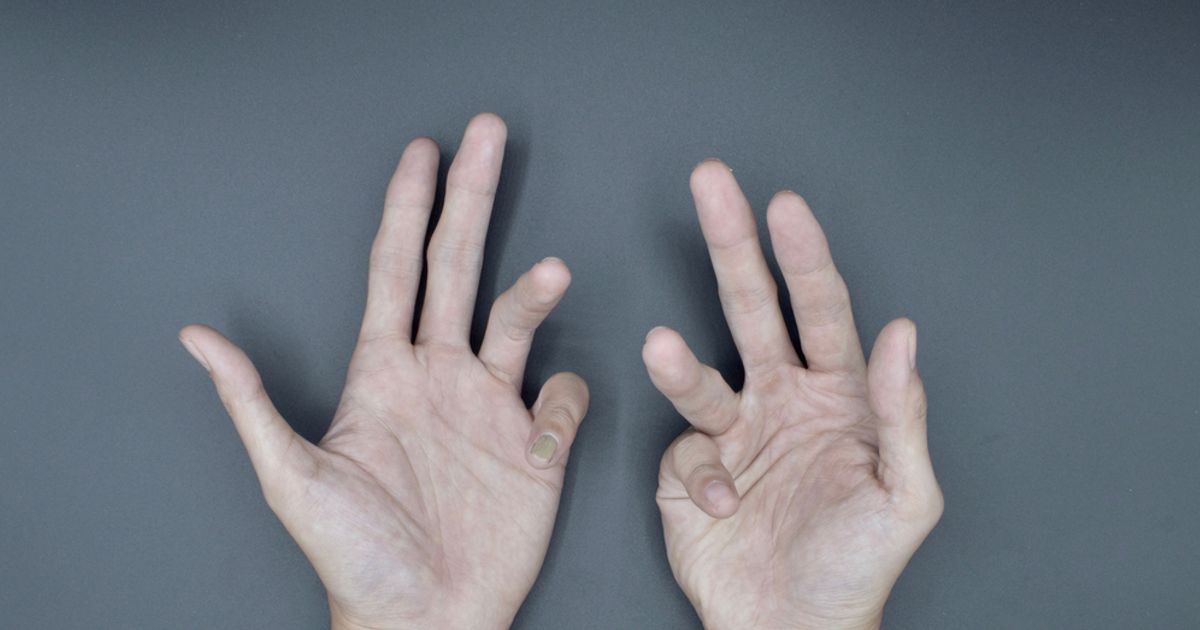 Contracture and Its Many Causes - Facty Health