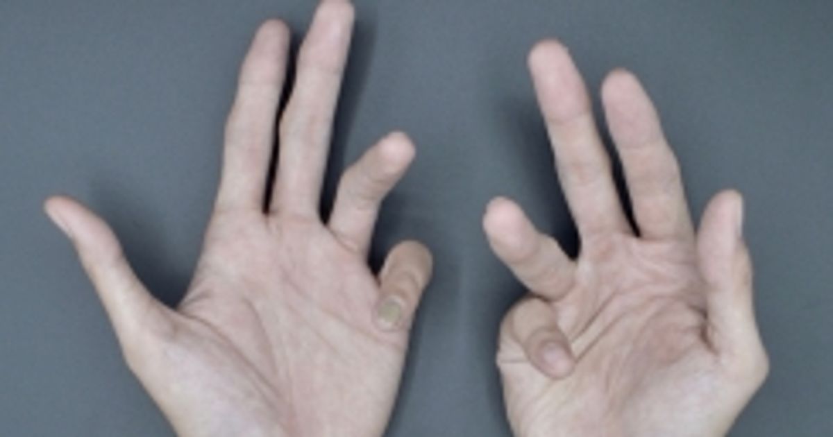Contracture and Its Many Causes - Facty Health